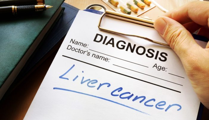 Liver cancer symptoms and treatment options: What to know | MD Anderson ...