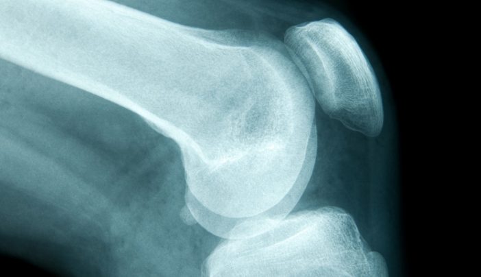 Can cancer treatment cause bone loss? | UT MD Anderson