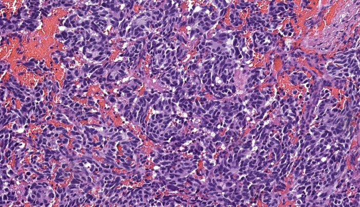 What are neuroendocrine tumors, and how are they treated? | UT MD Anderson