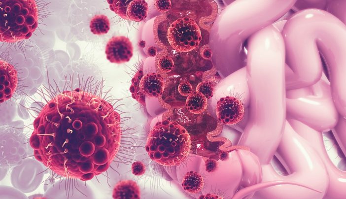 How can minimal residual disease guide colorectal cancer treatment ...