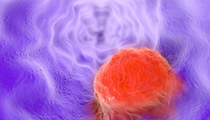 New research offers treatment advances for stomach and esophageal ...