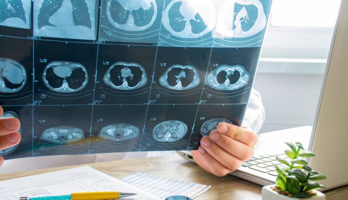 What changes with the updated lung cancer screening guidelines? | MD ...