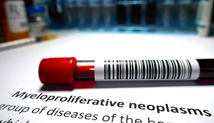 What are myeloproliferative neoplasms (MPNs)? 7 diagnosis and treatment ...