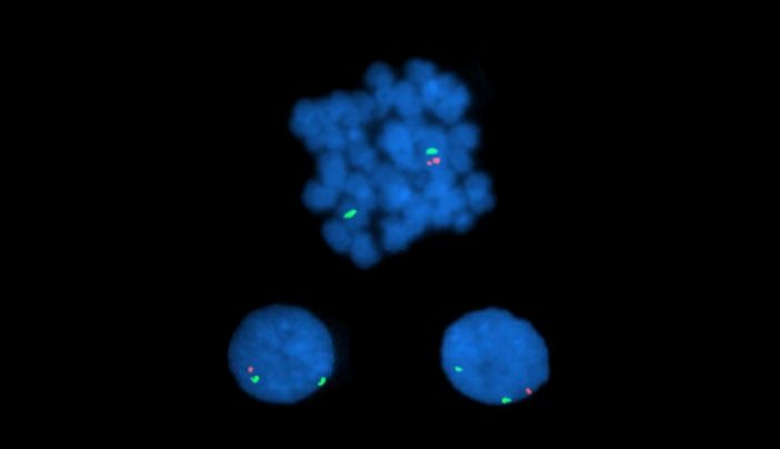 How fluorescence in situ hybridization (FISH) fits into cancer care ...
