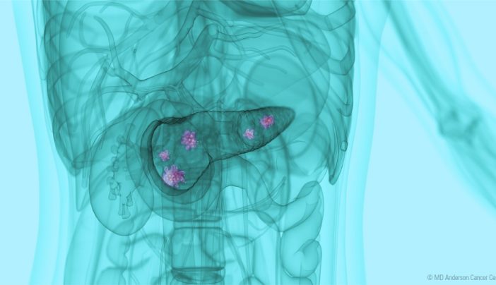 Diabetes and pancreatic cancer: What is the link? | MD Anderson Cancer ...