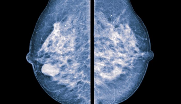 4 questions about breast calcifications, answered | MD Anderson Cancer ...