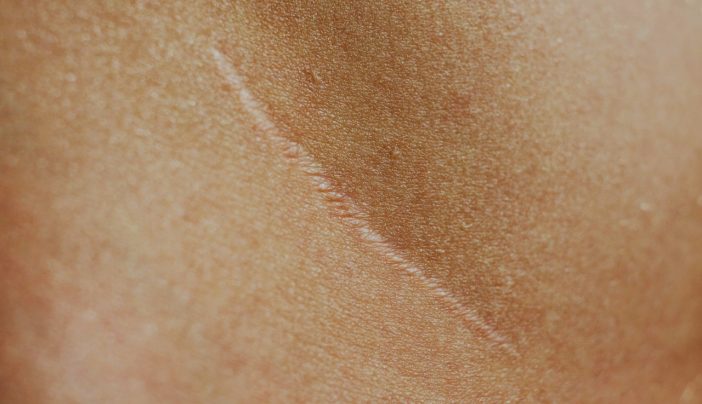 Caring for scar tissue after cancer surgery | MD Anderson Cancer Center
