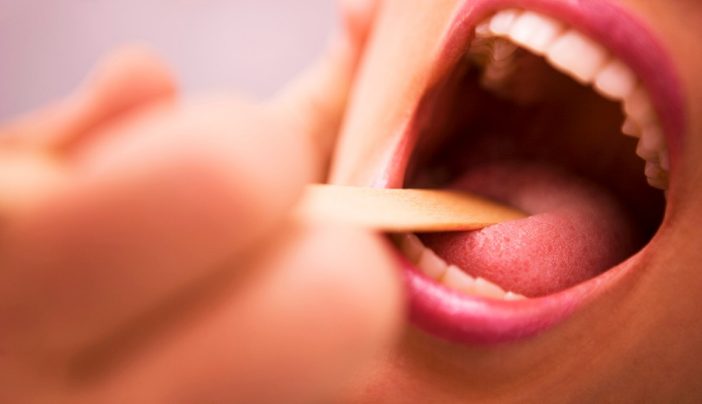 What does throat cancer look like? | MD Anderson Cancer Center