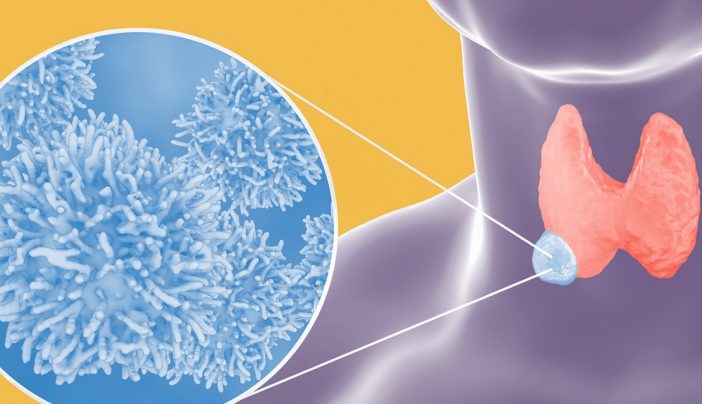 Common thyroid cancer symptoms to look for | MD Anderson Cancer Center