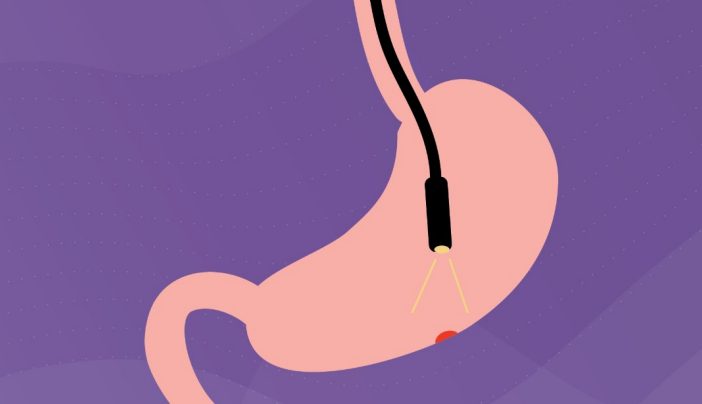 What are stomach polyps? | MD Anderson Cancer Center