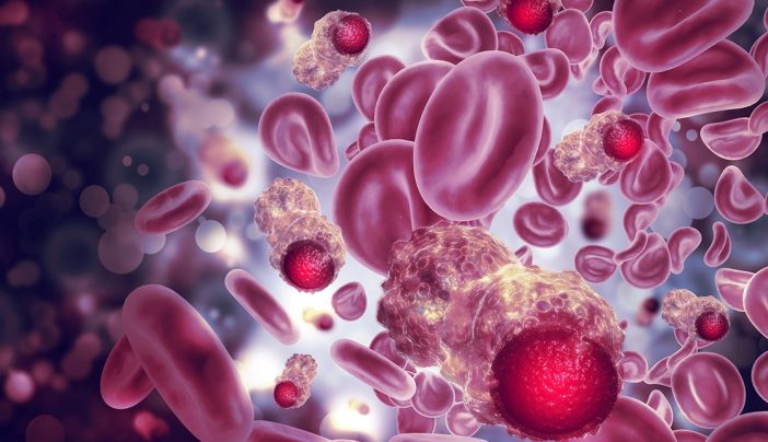 Smoldering myeloma: 6 facts | UT MD Anderson