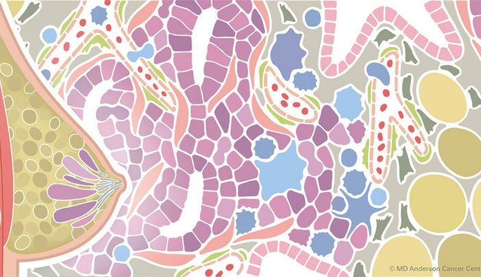 What is invasive lobular carcinoma? | MD Anderson Cancer Center