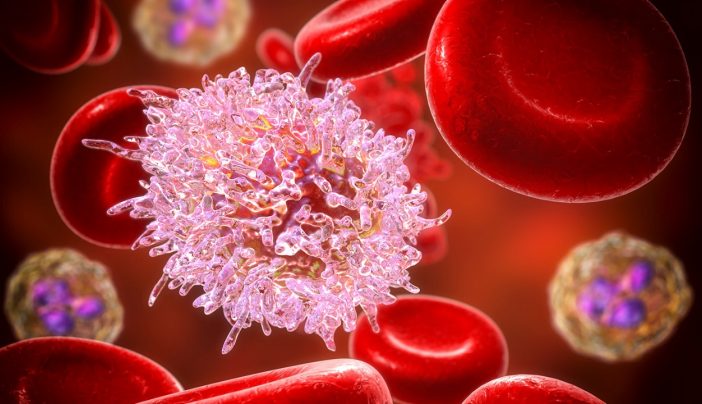 Hairy cell leukemia: 6 questions, answered | MD Anderson Cancer Center