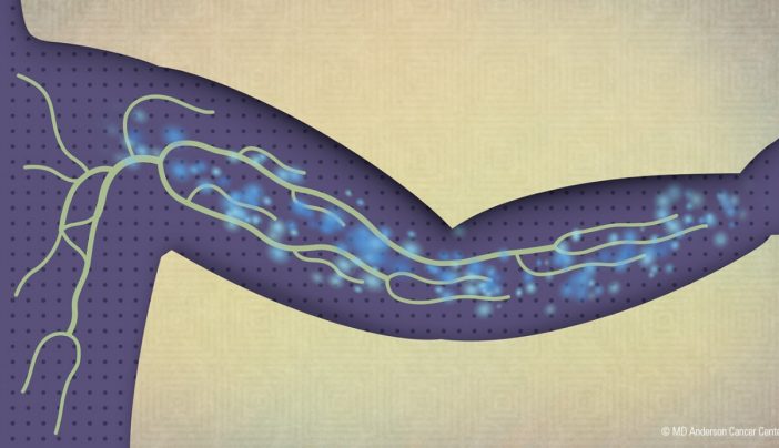 Surgical lymphedema treatment: 8 things to know | MD Anderson Cancer Center