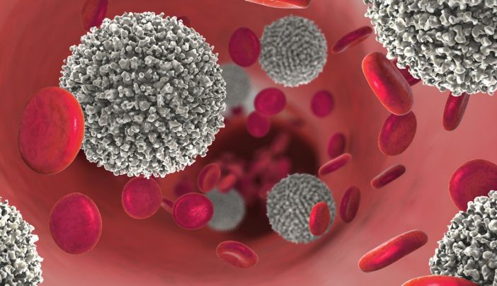 Types of leukemia: 5 things to know | MD Anderson Cancer Center