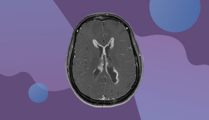 New research offers a path forward with treating leptomeningeal disease ...