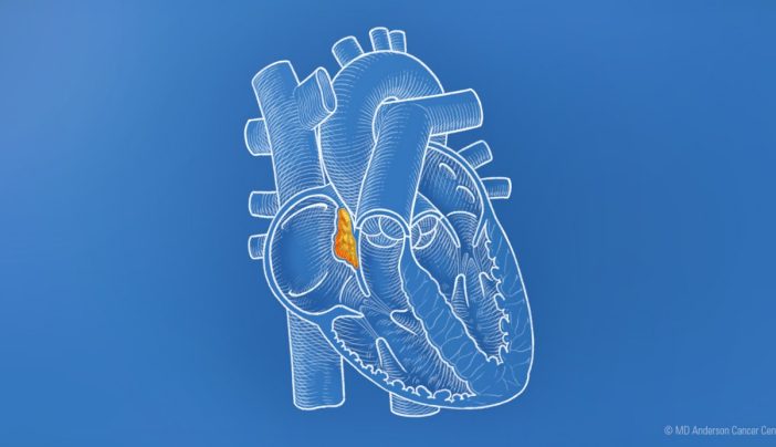 What is cardiac angiosarcoma? | MD Anderson Cancer Center