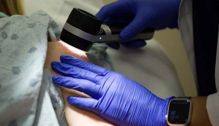 Nodular melanoma: 5 questions, answered | MD Anderson Cancer Center