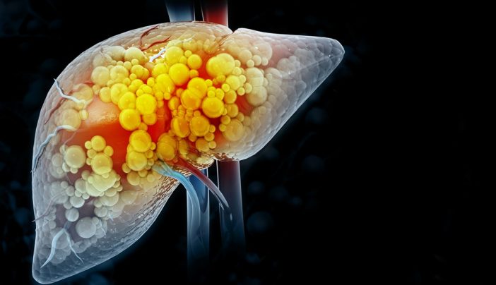 What’s new in treating hepatocellular carcinoma, the most common liver ...