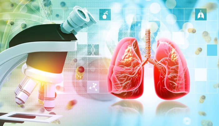 Squamous cell carcinoma of the lungs: 5 things to know | MD Anderson Cancer Center