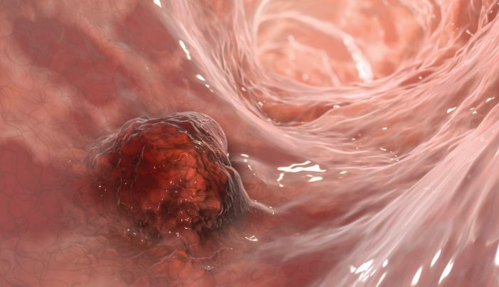 What happens if a doctor finds cancer during my colonoscopy? | MD ...