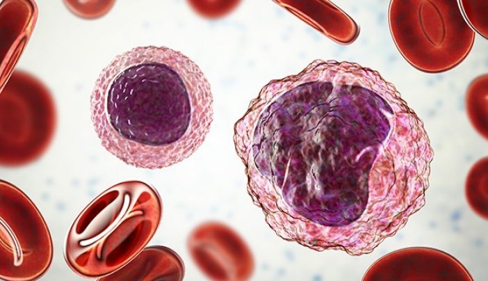 Marginal zone lymphoma: 4 things to know | MD Anderson Cancer Center