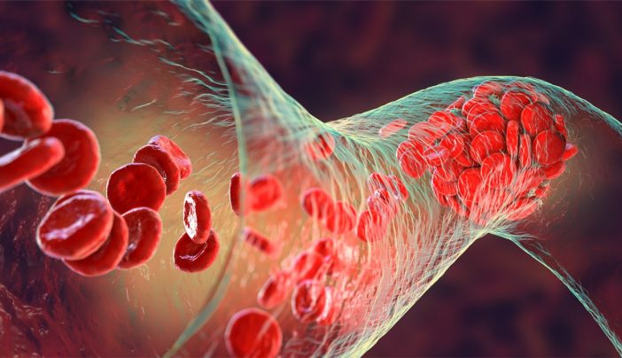 Deep vein thrombosis (DVT) as a side effect of cancer: 9 things to know ...