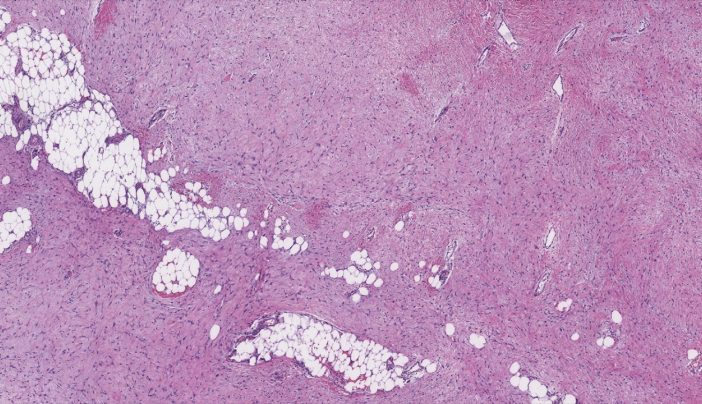 Desmoid tumors: 8 things to know | MD Anderson Cancer Center