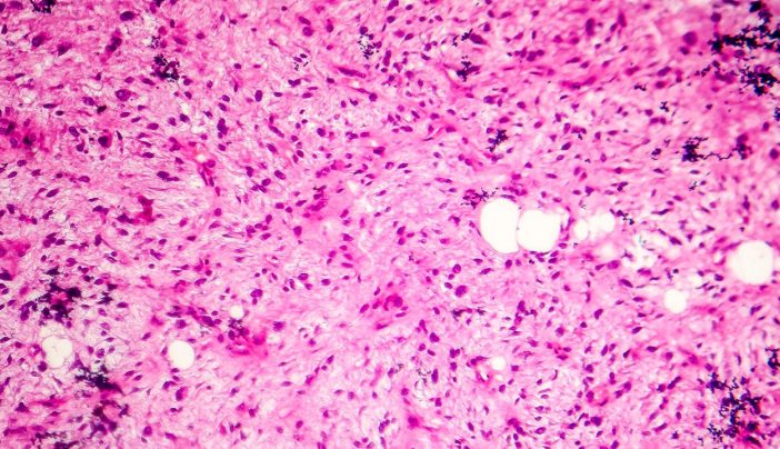 Newest research in sarcoma | MD Anderson Cancer Center