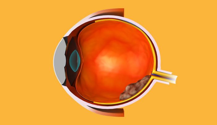 Retinoblastoma: 7 insights on this rare eye cancer | MD Anderson Cancer ...