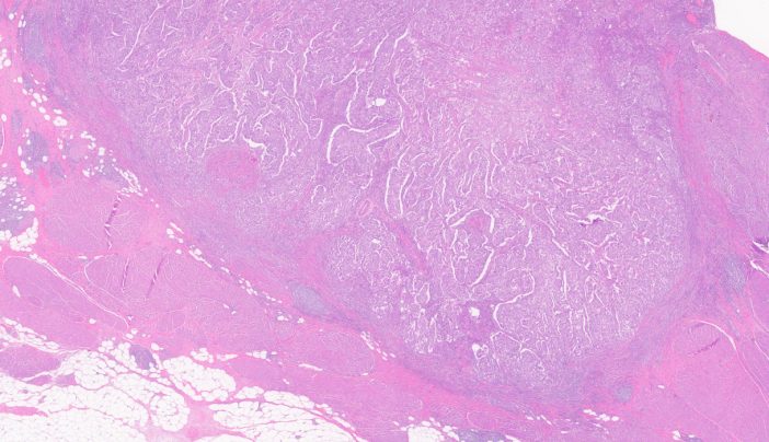 Urothelial carcinoma: 8 insights about this common bladder cancer | UT ...