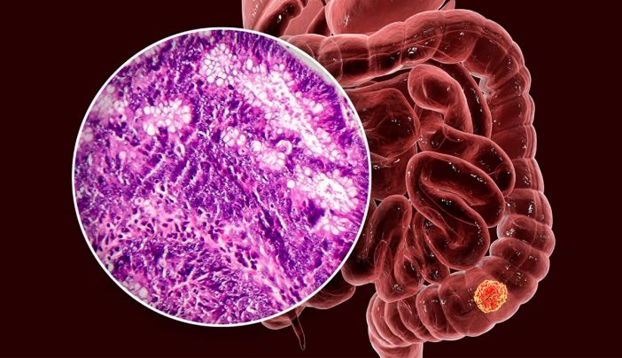 What are the risk factors for colorectal cancer? | MD Anderson Cancer ...