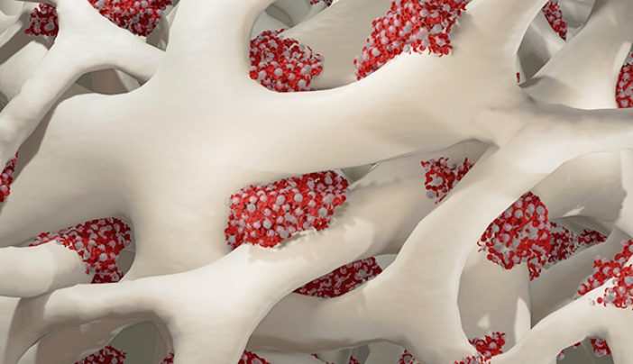 Bone marrow biopsy explained: Process, pain management and results | MD ...