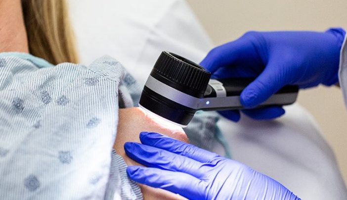 What does it mean if you have a raised mole? | MD Anderson Cancer Center