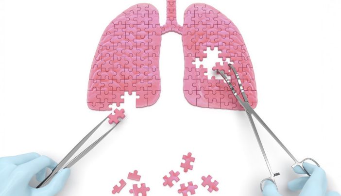 What is a lobectomy? | MD Anderson Cancer Center