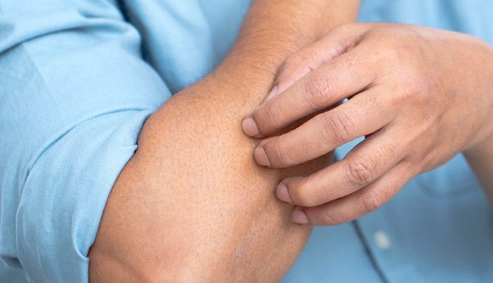What types of cancer can cause itchy skin? | MD Anderson Cancer Center
