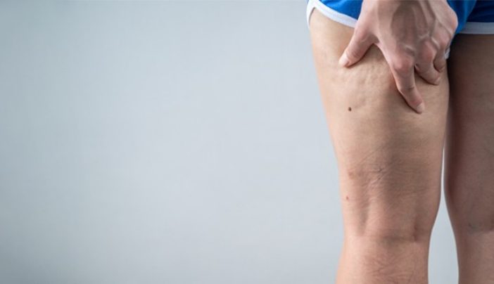 What are the symptoms of liposarcoma? | MD Anderson Cancer Center