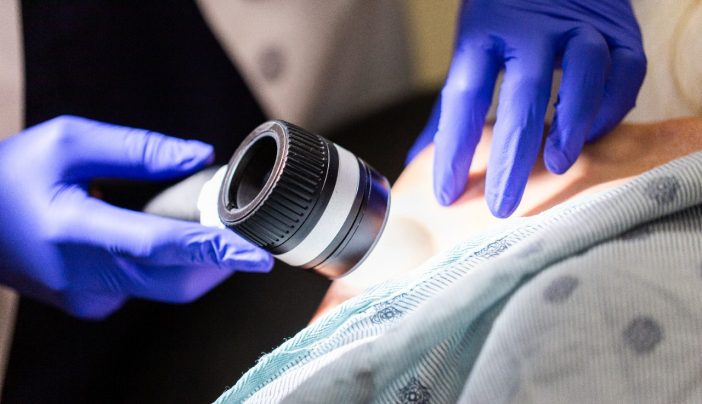 What to expect when you have a mole removed | MD Anderson Cancer Center