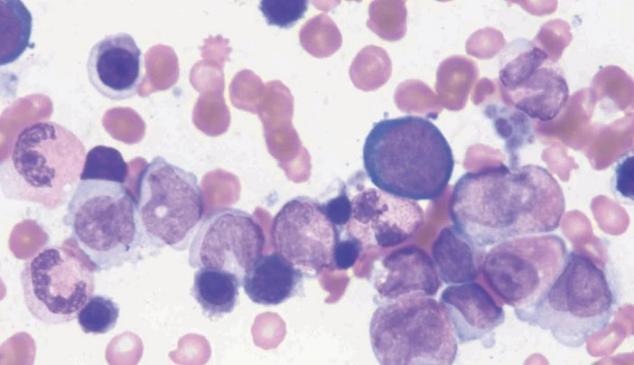 Chronic myelomonocytic leukemia (CMML): What to know about this rare cancer | MD Anderson Cancer ...