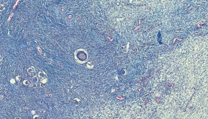 Neoplasms 101: What they are and how they’re treated | UT MD Anderson