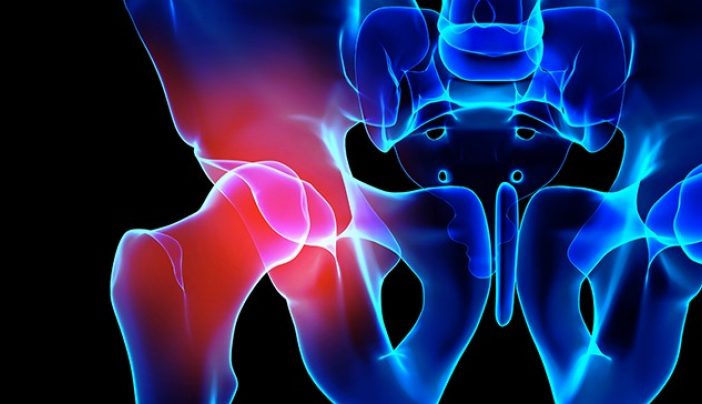 What is a hemipelvectomy? | MD Anderson Cancer Center