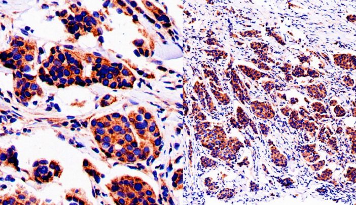 New advances in our understanding of cancer metabolism | UT MD Anderson