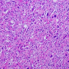 MD Anderson at SSO | MD Anderson Cancer Center