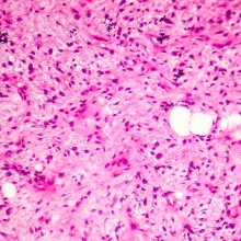 Soft Tissue Sarcoma Symptoms, Facts, Diagnosis, and Treatment | MD ...