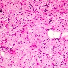 Soft Tissue Sarcoma Symptoms, Facts, Diagnosis, and Treatment | MD ...