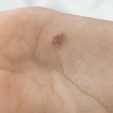 Skin Cancer | MD Anderson Cancer Center