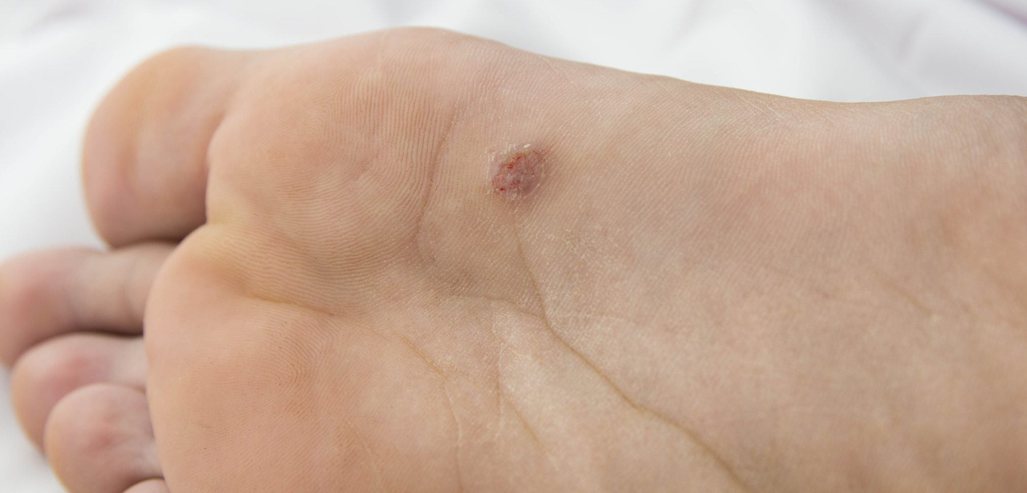 Amelanotic Melanoma Foot