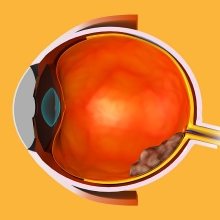 What is Eye Cancer? Symptoms, Risk Factors & Treatments | MD Anderson ...