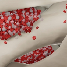 Leukemia: Definition, Types & Risk Factors | MD Anderson Cancer Center