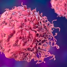 Mantle Cell Lymphoma | MD Anderson Cancer Center